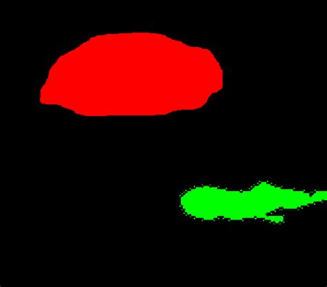 segmentation results white area is true segmented lesion green area