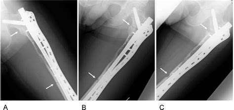 [pdf] Salvage Reconstruction With The Masquelet Technique Following Wide Resection For