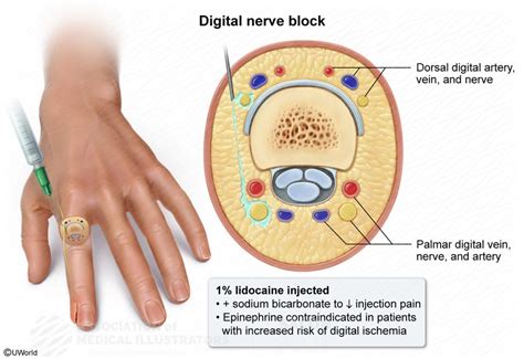 Digital Nerve Block Ami Meeting 2021