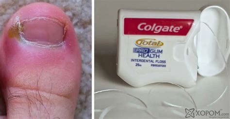 Найзын маань хөлийн хумс шигдэж ургаад байдаг байв Харин тэр эдгээр 8