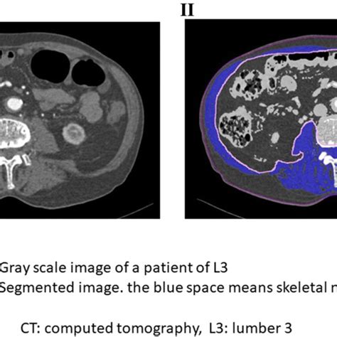Skeletal Muscle Measurements Based On Computed Tomography Area And Density Download Scientific
