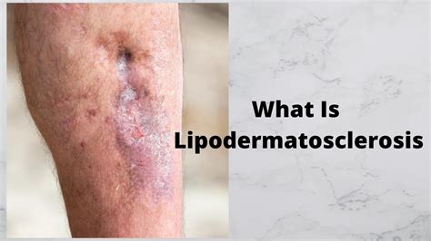 What Is Lipodermatosclerosis Youtube