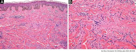Annular Elastolytic Giant Cell Granuloma An Unusual Presentation In Non Sun Exposed Areas