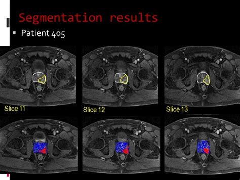 Post Processing Of Prostate Perfusion Mri