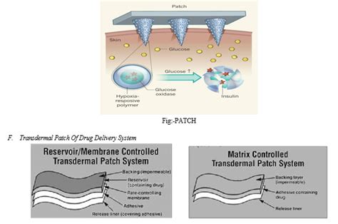 Formulation Development And Cevaluation Of Mucoadhesive Patch For Diabetes