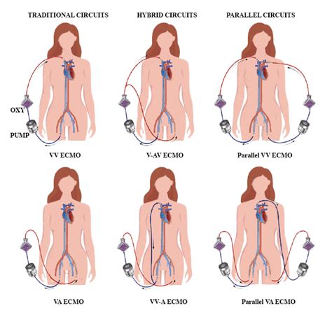 Ecmo Circuit