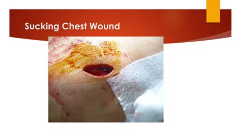 Penetrating Chest Injurypdf