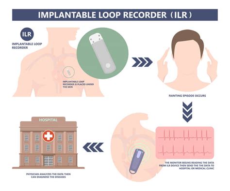 Loop Recorder Implantation Sydnor Cardiovascular Center