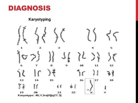 Fragile X Syndrome Karyotype