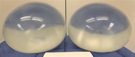 Of A Set Of Breast Implants Rabsoluteunits