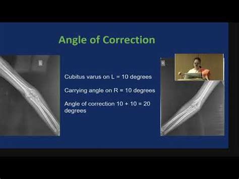 Decision Making In Angular Deformities Around The Elbow YouTube