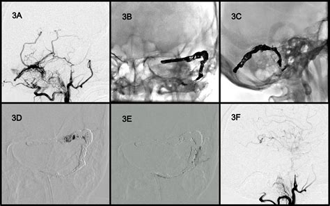 Frontiers Grouting Technique—combining Transvenous Onyx And Coils For The Embolization Of