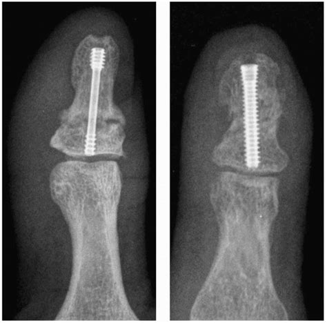 Angular Deformities Of The Lower Extremities Teachme Orthopedics