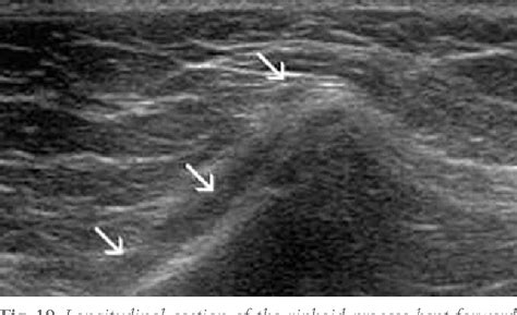 Xiphoid Process Lump Symptoms Modernhealcom