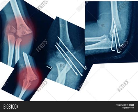 Humerus Fracture X Ray