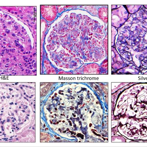 Glomeruli With Global Endocapillary Hypercellularity With Leukocytes Download Scientific