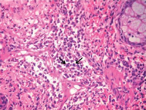 Different Faces Of Leukemia Cutis Presenting As Purpura Fulminans And