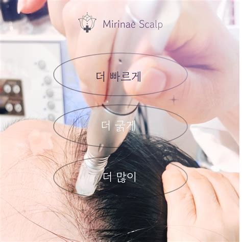 미리내스칼프 탈모케어의 명소 미리내스칼프👍 제대혈 줄기세포 배양액 액소좀 순수 줄기세포배양액