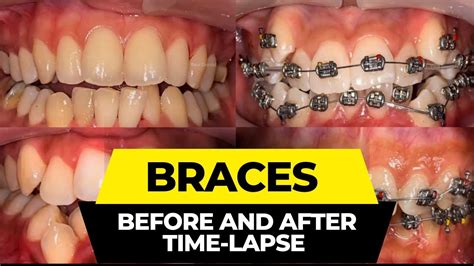 Braces Before And After Time Lapse Orthodontic Treatment Your