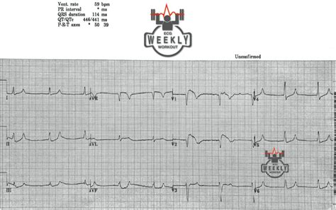 Differential Diagnoses New Right Axis Deviation And ST Segment Elevation ECG Weekly