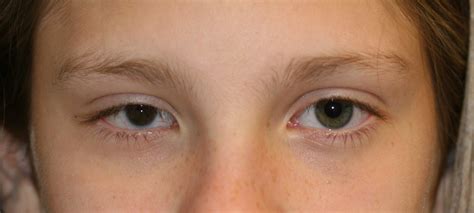 Enophthalmos Right Eye Maxillary Sinus Mucocele