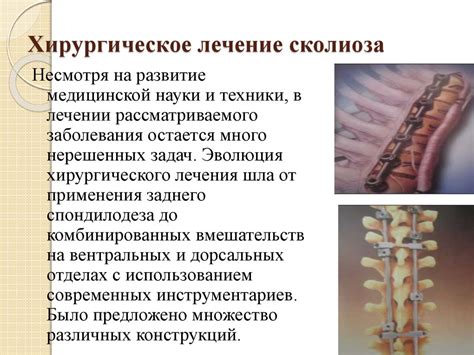 Лечебная физическая культура при сколиотической болезни Online Presentation