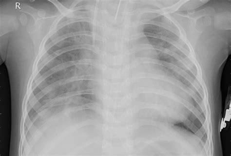Xray Classification Model By Aap Assignment