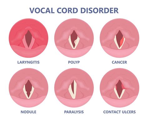 Understanding Vocal Cord Dysfunction Laryngoscopy Vs Videostroboscopy