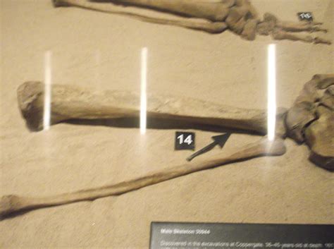 HISTORY OF A BECK Mesolithic Human Tibia Shaft Excavated From The Stainton Gravel Beds