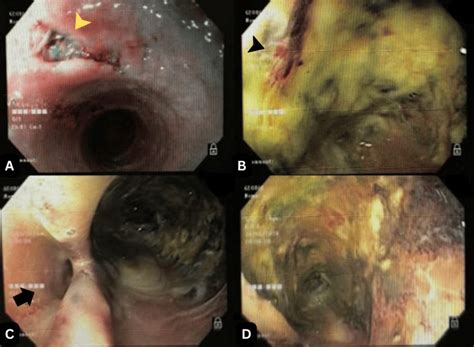 Severe E Cigarette Induced Esophagitis In A Patient With Eosinophilic