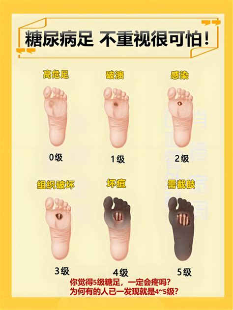 青大附院 糖尿病足专病门诊正式开诊啦 青海大学附属医院