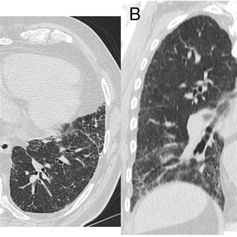 Patient With The Ct Diagnosis Of Definitive Uip On The Axial Image A