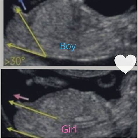 علائم سونوگرافی برای تعیین جنسیت جنین مجله اینترنتی فرزند پاک