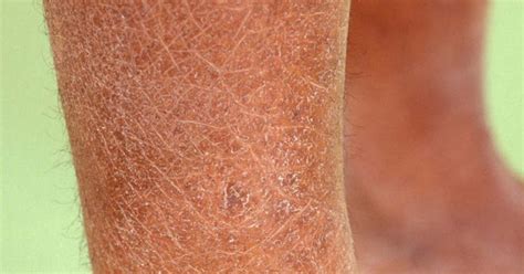 What Is Xerosis Teroes