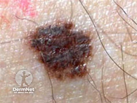 Reticular Pattern Clinical Image