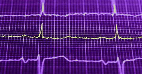 What Is Electrocardiography Ekg Ecg