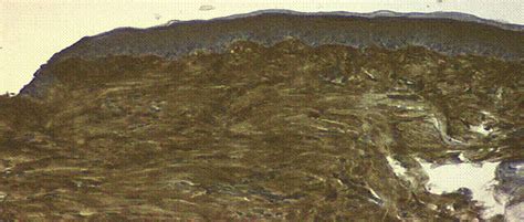 Cytoplasmic Immunohistochemical Expression Of Tgf β1 In Dermis×20 A