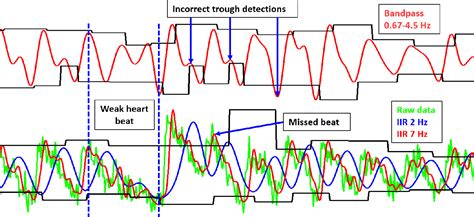 Figure 4 From A Robust Method Of Peak Detection In Noisy Ppg Signals Using A Structure Of Iir