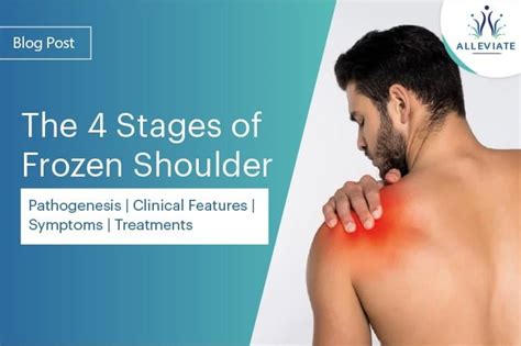 4 Stages Of Frozen Shoulder Pathogenesis Clinical Features Symptoms