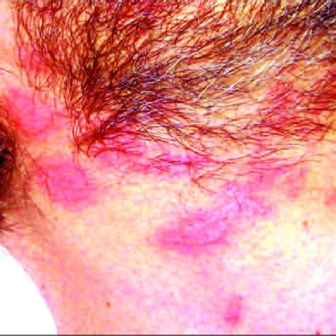 Atypical Pyoderma Gangrenosum Download Scientific Diagram