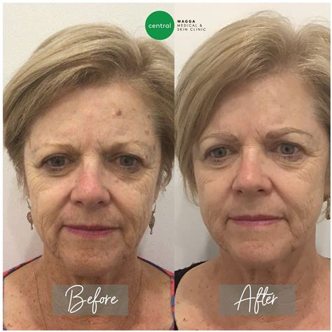 Laser Genesis — Central Wagga Medical Skin Cancer Medical Aesthetics