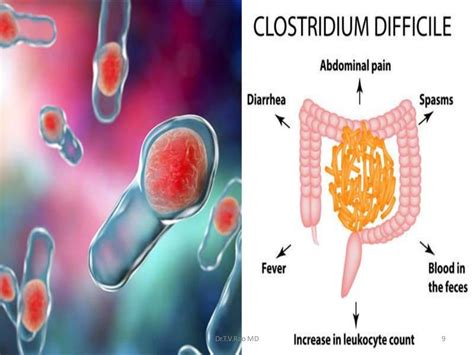 Clostridium Difficile By Dr T V Rao Md