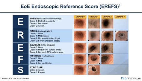 Diagnosestellung Bei Eoe Eoe Endoskopische Diagnose Pbff