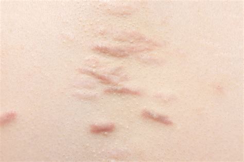 켈로이드 Keloid 피부 질환 유토이미지 상세페이지 베이직샵 사진 22291067