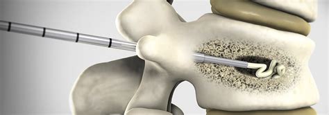 Treating Your Compression Fracture With Kyphoplasty