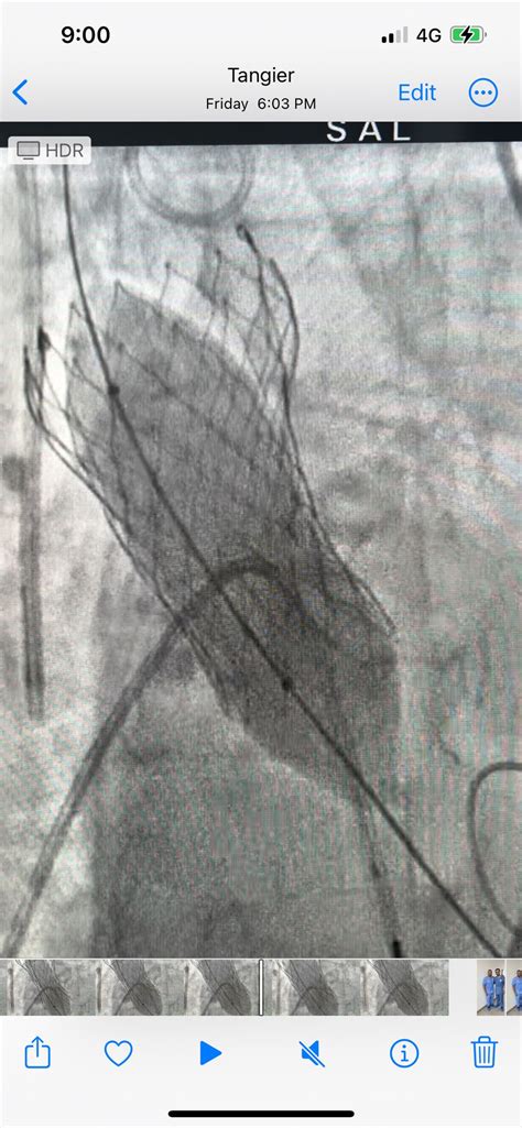 Ahmad Elsayed Yousef Md Fscai On Linkedin Tavi Medtronic