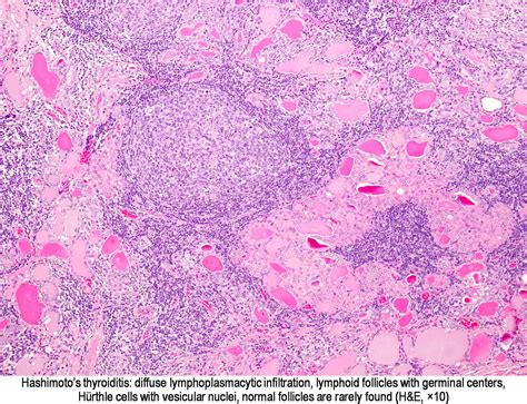 Pathology Outlines Hashimoto Thyroiditis