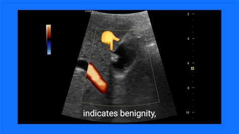 Gallbladder Polyps Explained Ultrasound And Color Doppler Findings Diagnosis And Management