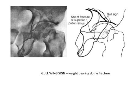 Imaging And Classification Of Acetabular Fractures Pptx