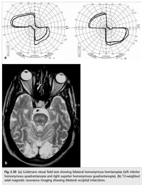 Neuro Ophthalmology Question Of The Week Bilateral Occipital Lobe Lesions And Visual Acuity